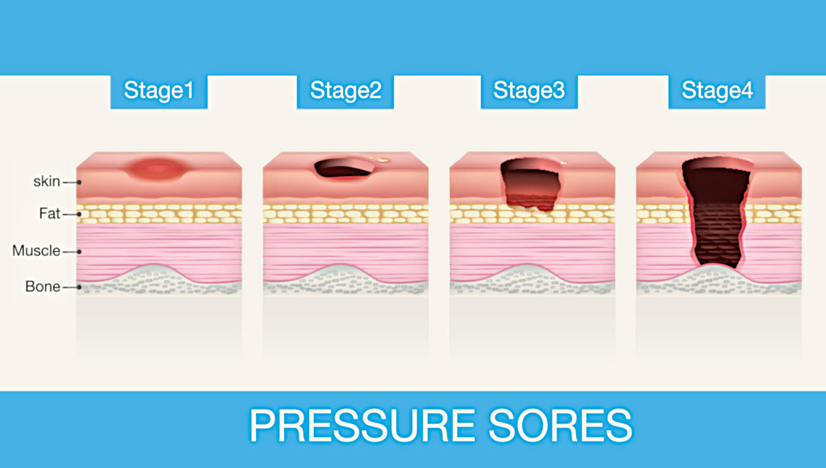 Pressure Injury Stages What They Are And Why They Matter 41 OFF Pressure Injury Stages What They Are And Why They Matter 41 OFF